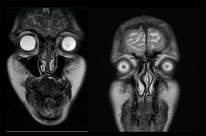 Mri Face Scans Horror Amino